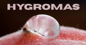 Hygromas: Causes, Symptoms, Diagnosis and Treatment